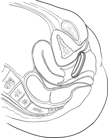 Pessary | SpringerLink