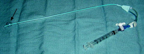 Hysterosalpingography/Hysterosalpingogram (HSG) | SpringerLink