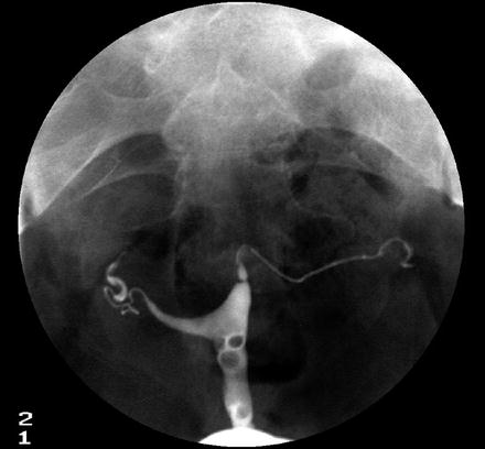 Hysterosalpingography/Hysterosalpingogram (HSG) | SpringerLink