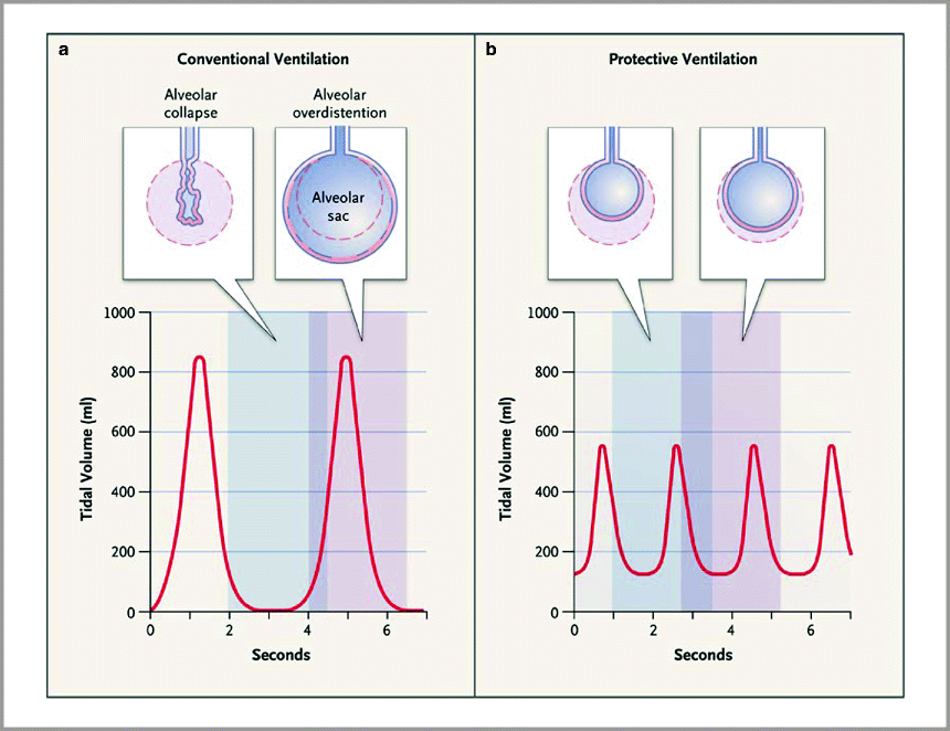 Acute Lung Injury (ALI) and Acute Respiratory Distress Syndrome (ARDS ...