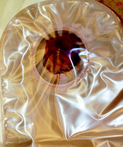 Colostomy: Types, Indications, Formation, and Reversal | SpringerLink