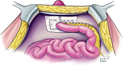 Parastomal Hernia | SpringerLink