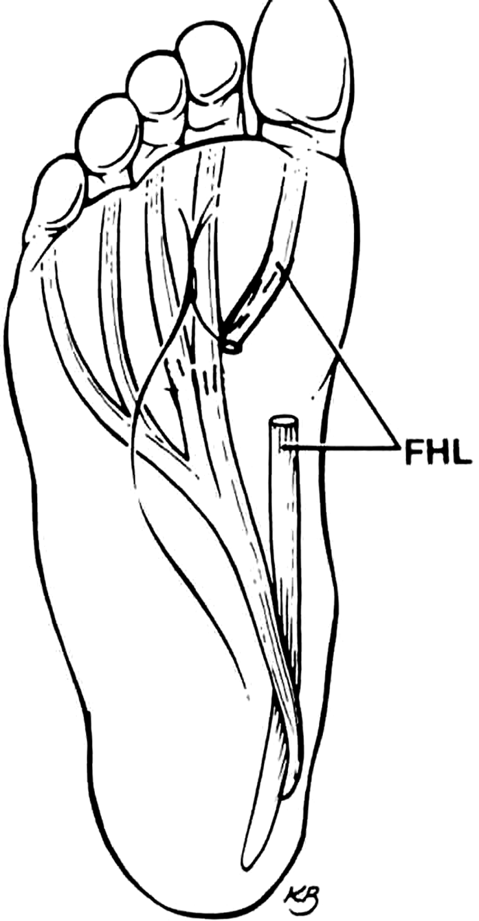 Treatment of Chronic Achilles Tendon Ruptures with Tendon Transfers ...