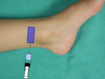 Ankle Blocks | SpringerLink