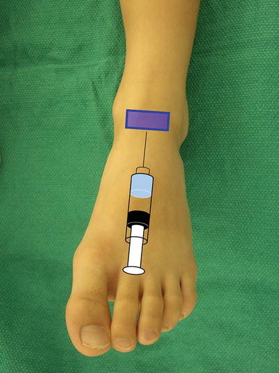 Ankle Blocks | SpringerLink