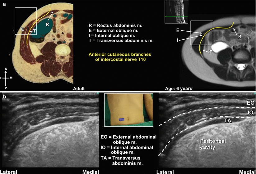 Rectus Sheath and Transversus Abdominis Plane (TAP) Blocks | SpringerLink