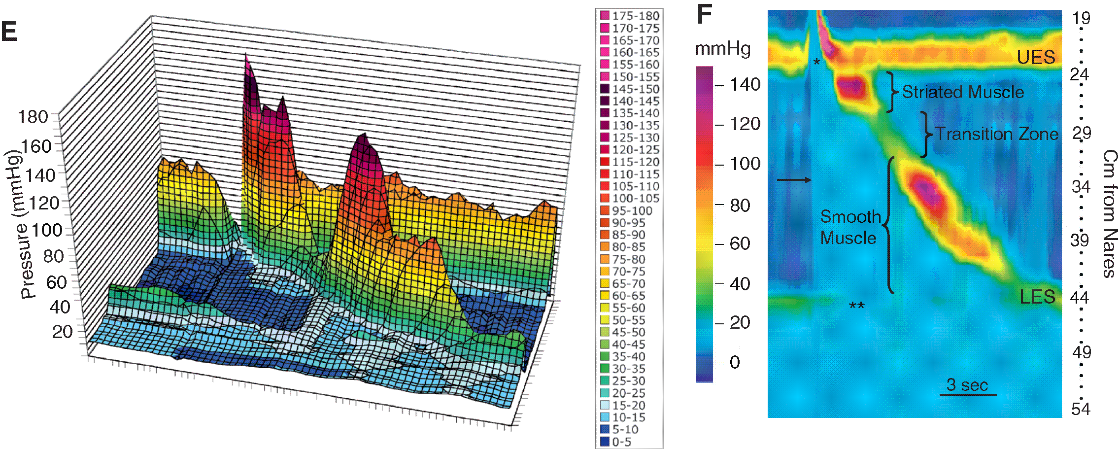 Introduction to High-Resolution Manometry | SpringerLink