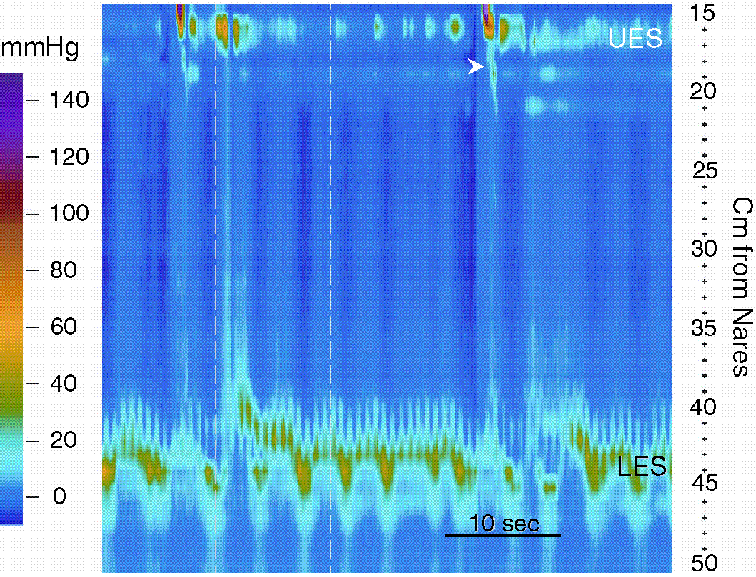 Esophageal Manometry | SpringerLink