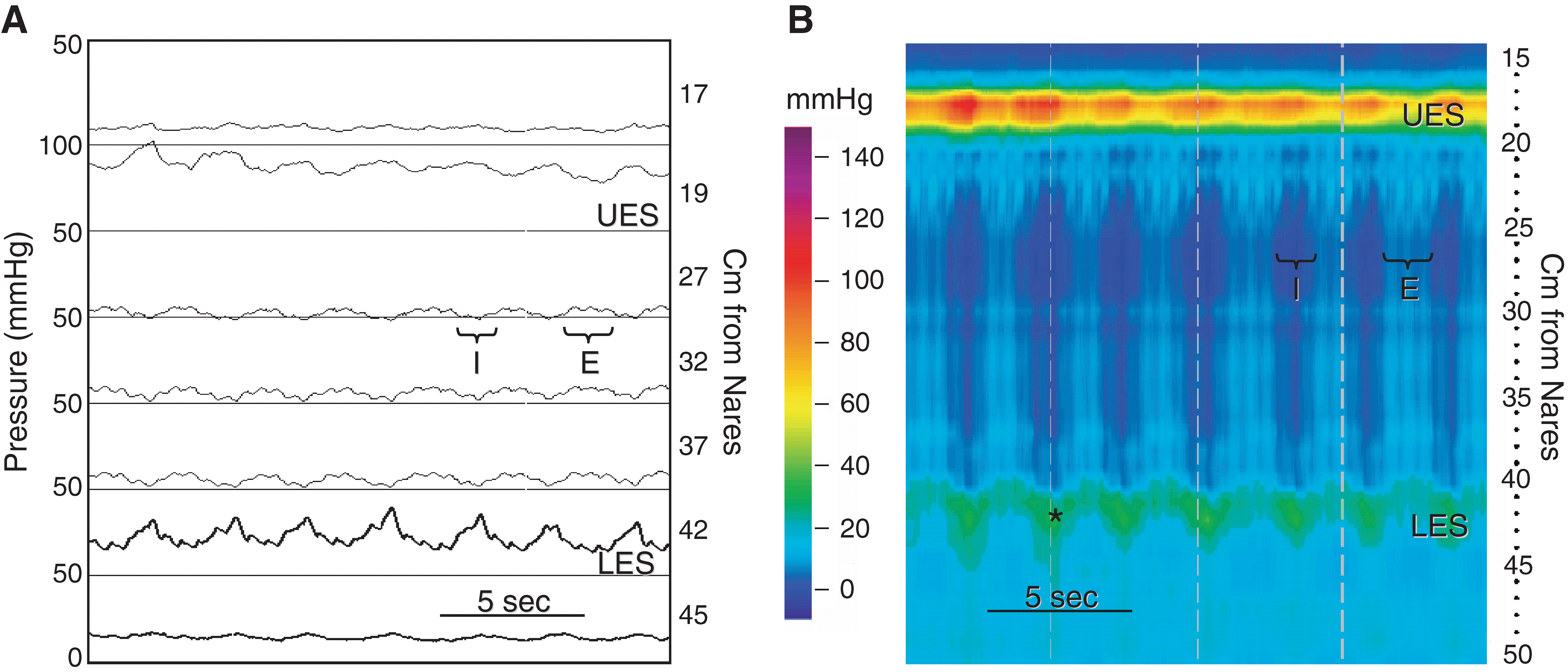 Esophageal Manometry | SpringerLink