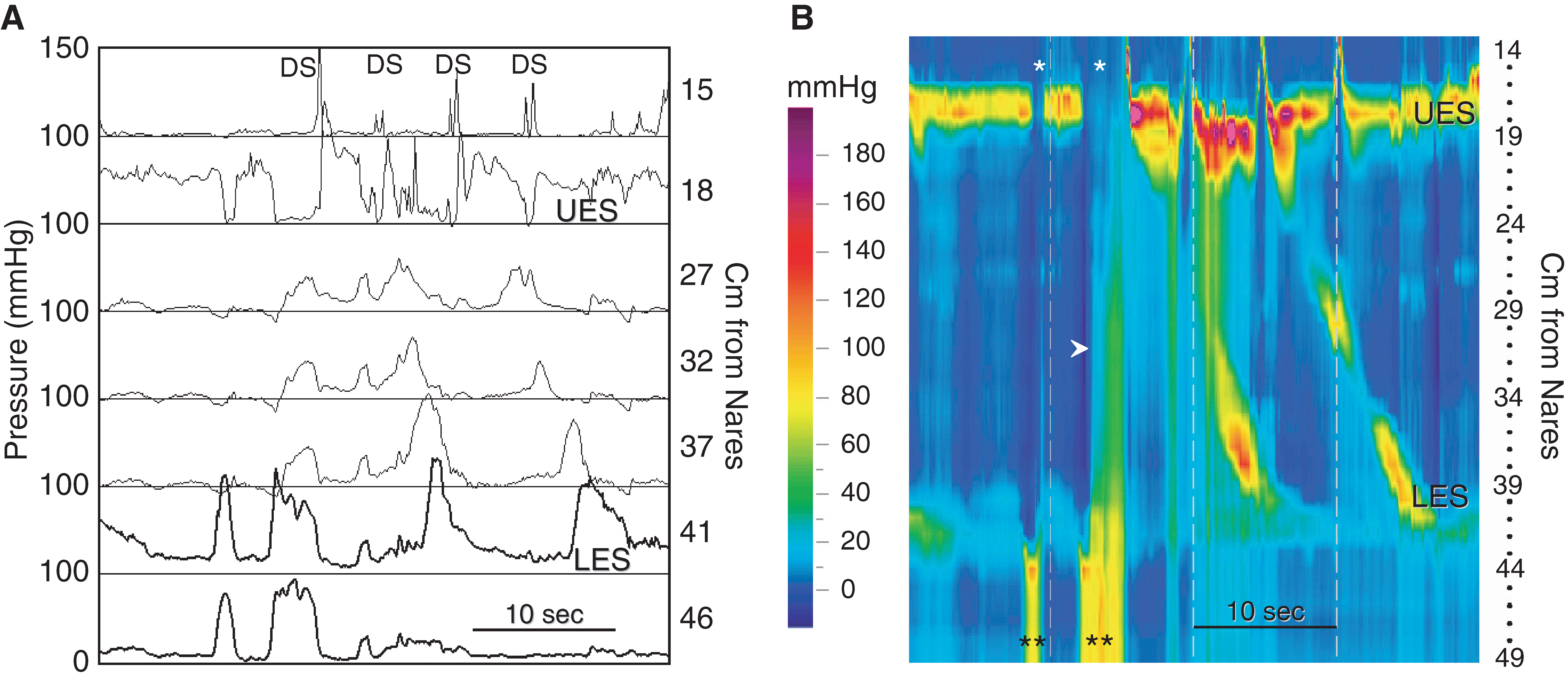 Esophageal Manometry | SpringerLink