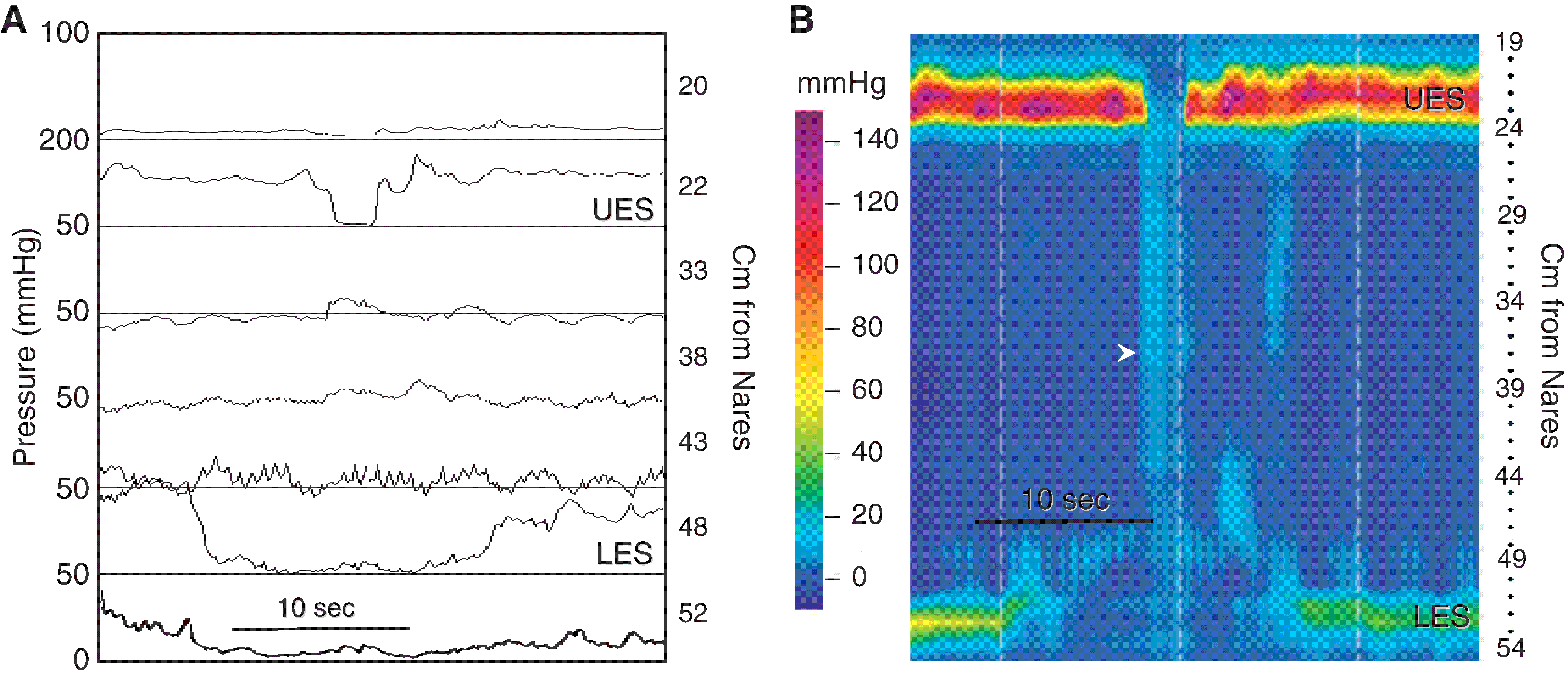 Esophageal Manometry | SpringerLink
