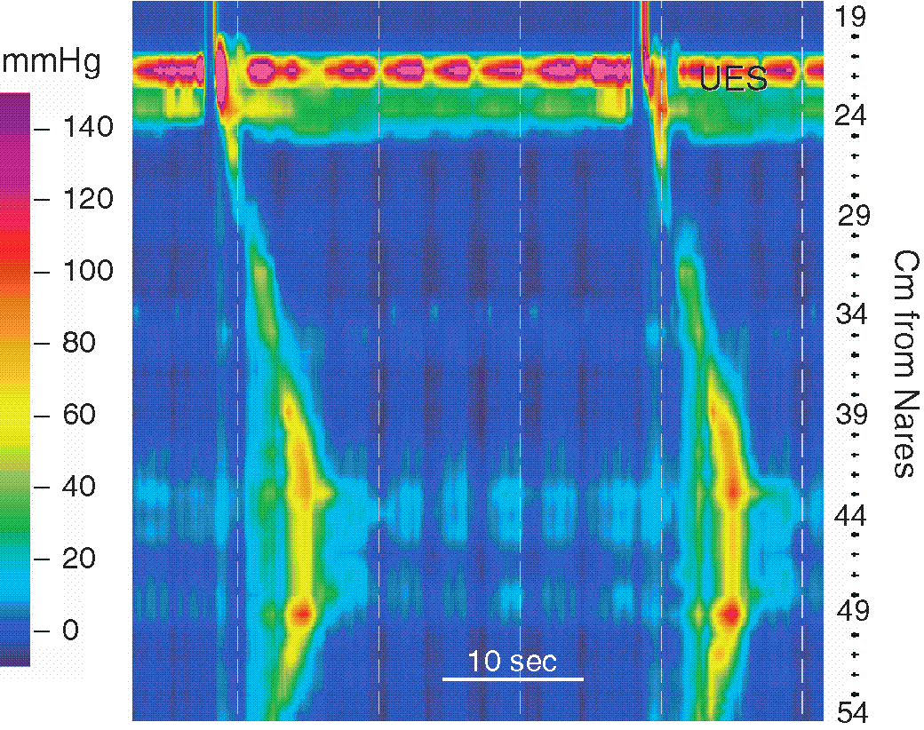 Esophageal Manometry | SpringerLink