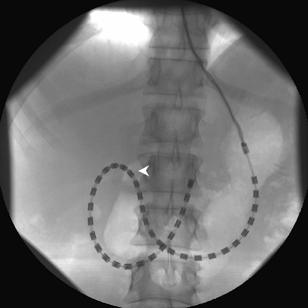 Gastric/Small Bowel Manometry | SpringerLink