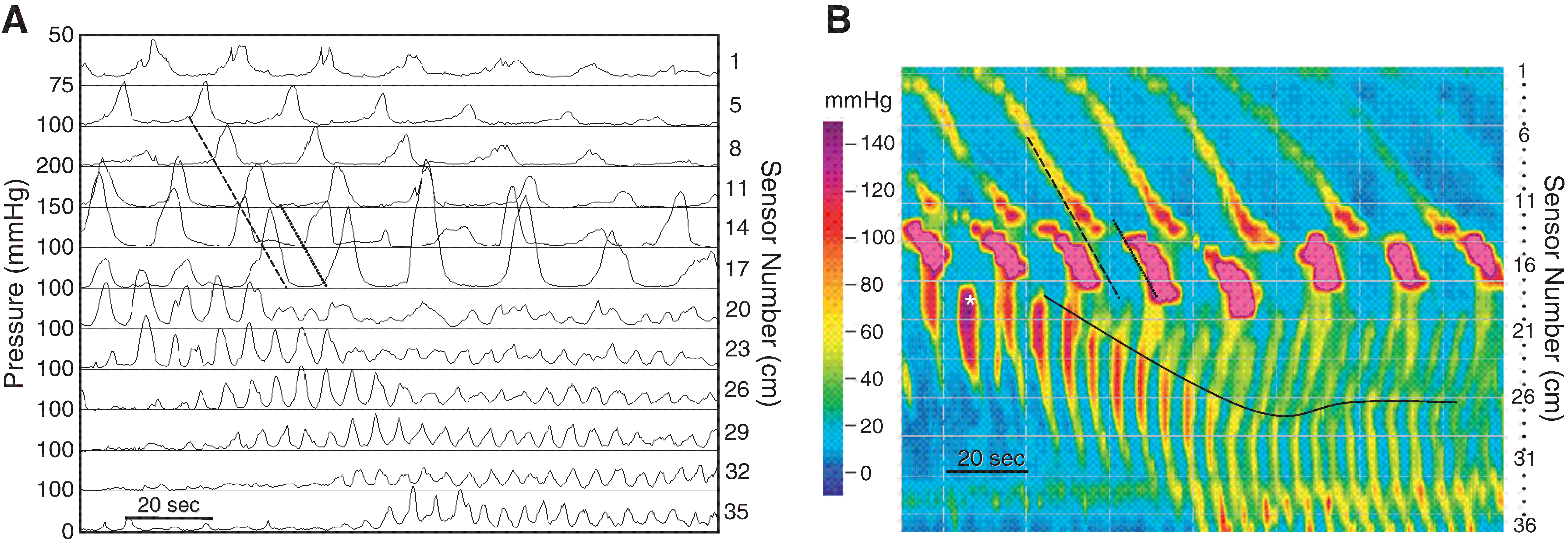 Gastric/Small Bowel Manometry | SpringerLink