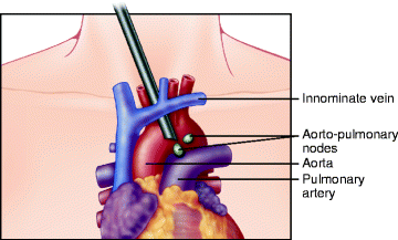 Mediastinoscopy | SpringerLink