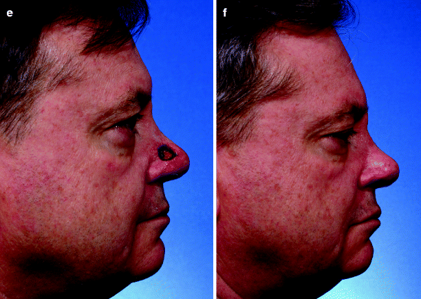 Reconstruction of Nasal Facet, Ala, and Caudal Sidewall: Three ...