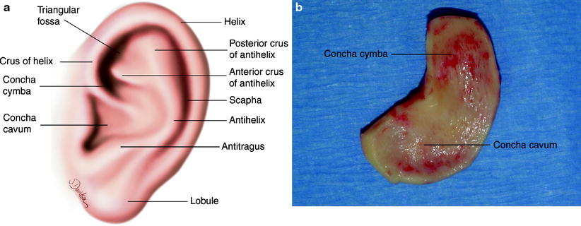 Cartilage Grafts | SpringerLink