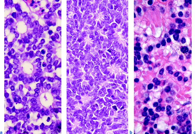 Clinical Features, Diagnosis, Pathology | SpringerLink