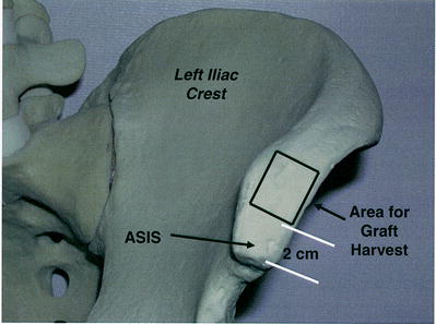 Iliac Crest Bone Graft Harvest and Fusion Techniques | SpringerLink