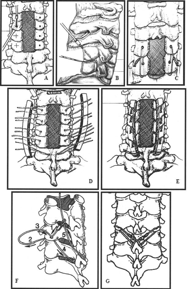 Posterior Cervical Instrumentation and Fusion | SpringerLink