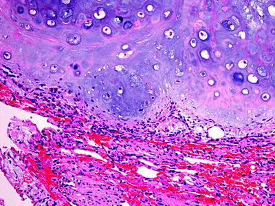 Pulmonary Chondroma | SpringerLink