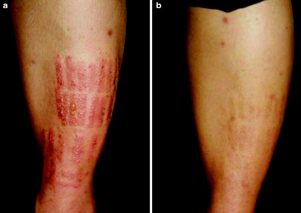 Laser for Hair Removal | SpringerLink