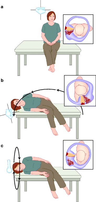 Peripheral Vestibular Forms of Vertigo | SpringerLink