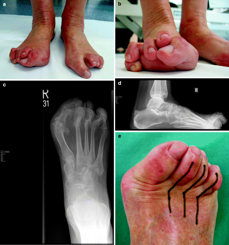 Surgical Treatment of Hammer Toe, Claw Toe, and Mallet Toe Deformity ...