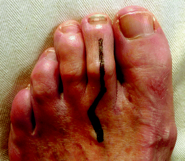 Surgical Treatment of Hammer Toe, Claw Toe, and Mallet Toe Deformity ...