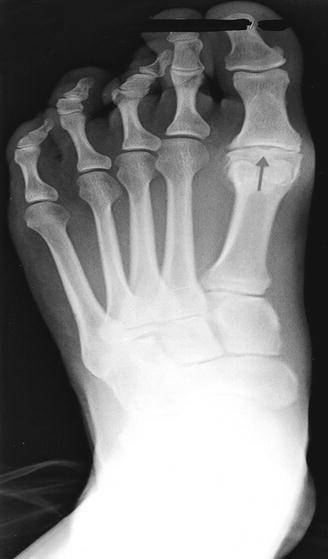 Hallux Rigidus: First Metatarsal Head Resurfacing | SpringerLink