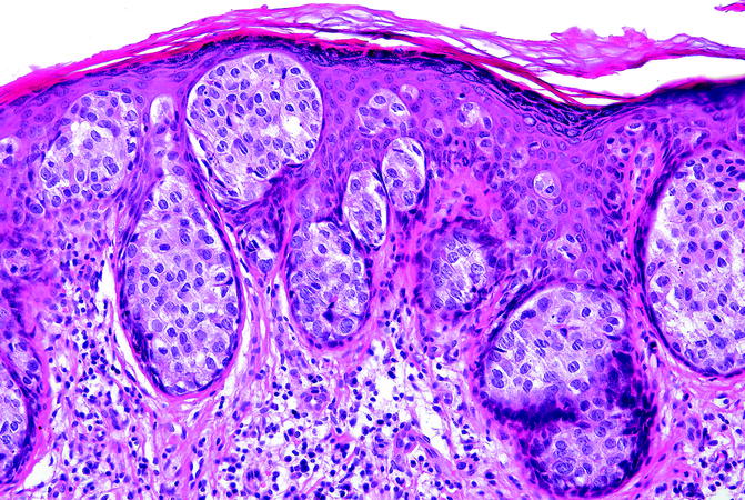 Skin Adnexal Tumors | SpringerLink