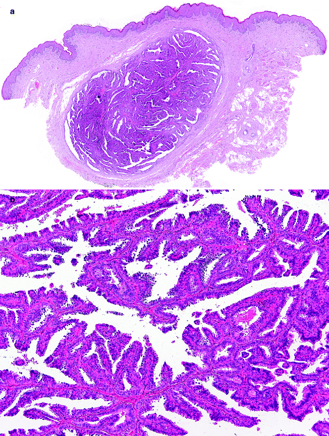Skin Adnexal Tumors | SpringerLink