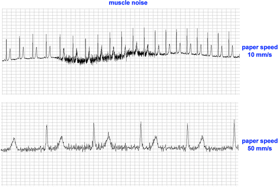 An Introduction to ECG Signal Processing and Analysis | SpringerLink