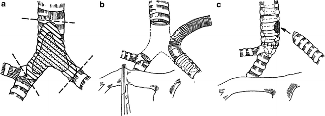 Tracheal Resection and Reconstruction | SpringerLink