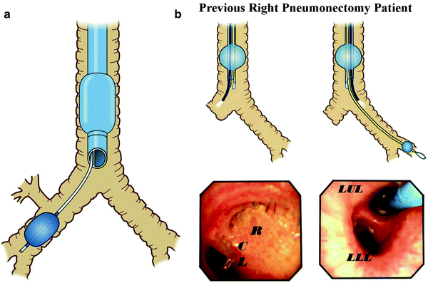 Lung Isolation | SpringerLink