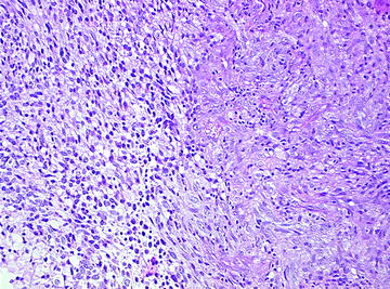 Pathology of Glioblastoma Multiforme | SpringerLink