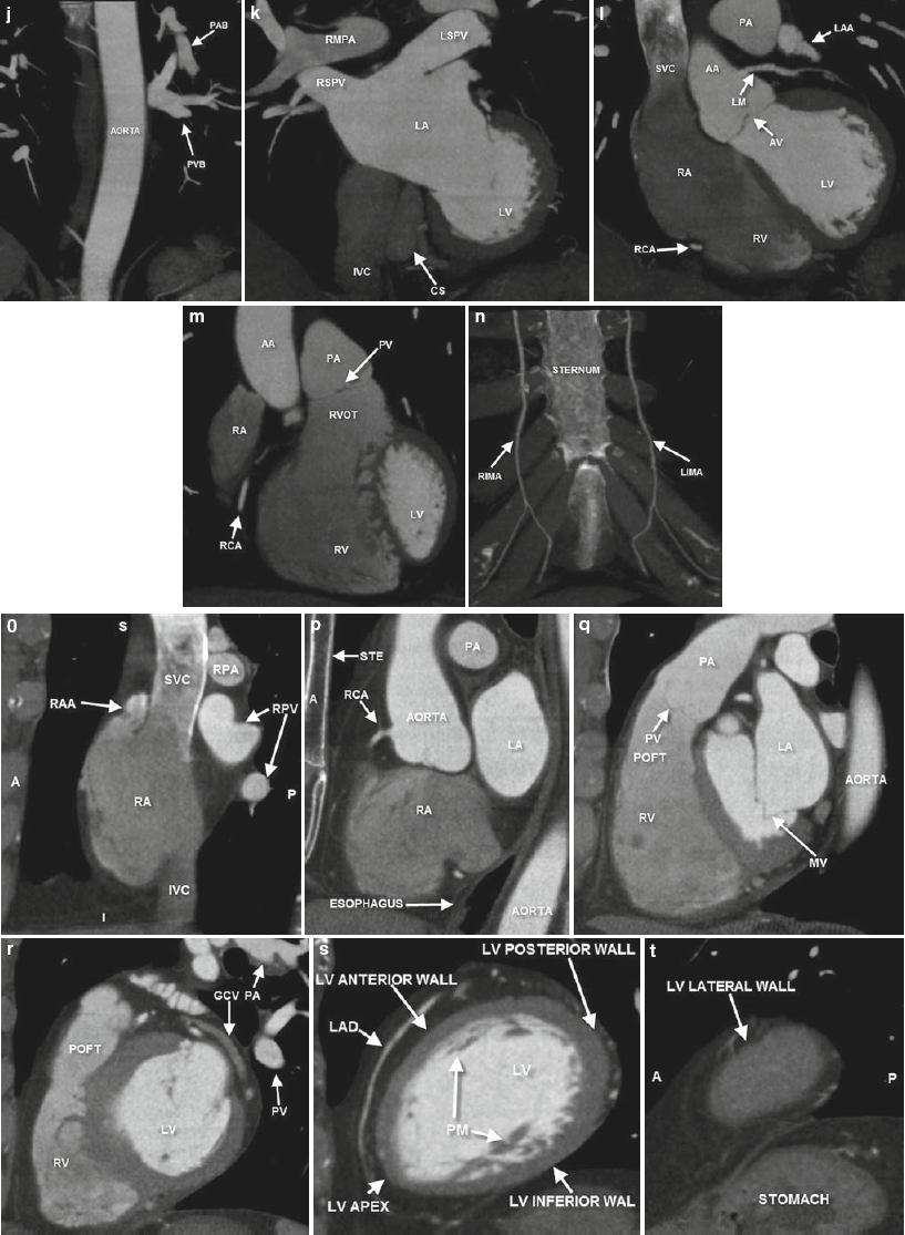 Coronary Anatomy | SpringerLink