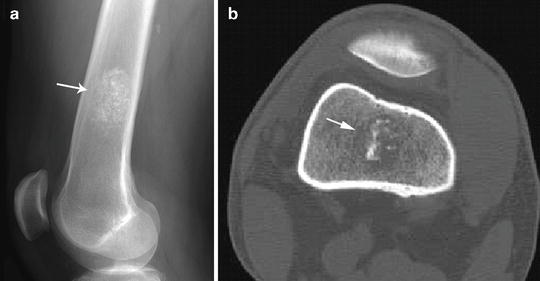 How to Evaluate a Bone Lesion | SpringerLink