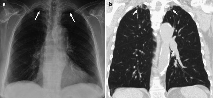 Imaging Features of the Normal Aging Chest | SpringerLink