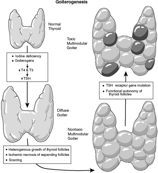 Pathology of Thyroid Gland | SpringerLink
