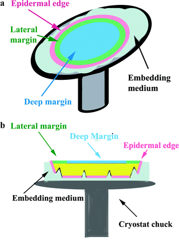 Frozen Section Techniques Used in Mohs Micrographic Surgery | SpringerLink