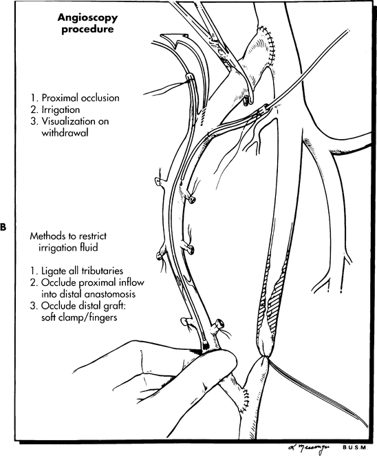 Angioscopy: Instrumentation, Techniques, and Applications | SpringerLink