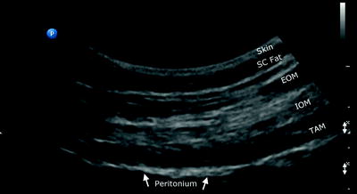 Ultrasound-Guided Transversus Abdominis Plane (TAP) Block | SpringerLink