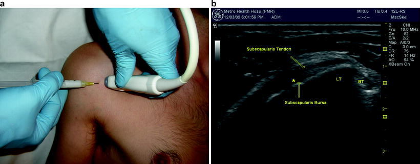 Ultrasound-Guided Shoulder Joint and Bursa Injections | SpringerLink