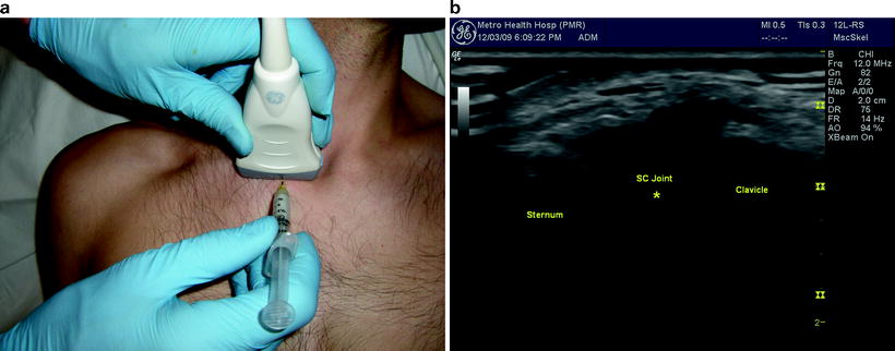 Ultrasound-Guided Shoulder Joint and Bursa Injections | SpringerLink