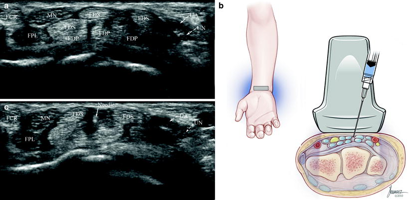 Ultrasound-Guided Hand, Wrist, and Elbow Injections | SpringerLink