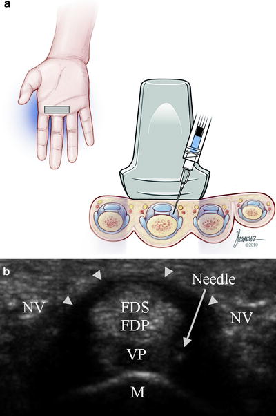 Ultrasound-Guided Hand, Wrist, and Elbow Injections | SpringerLink