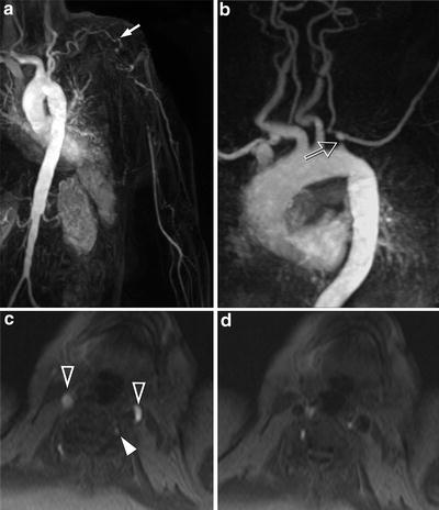 MRA: Upper Extremity and Hand Vessels | SpringerLink