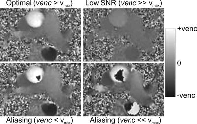 Phase-Contrast MRI and Flow Quantification | SpringerLink