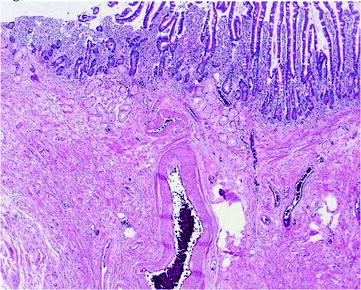 Management of Dieulafoy’s Lesions | SpringerLink